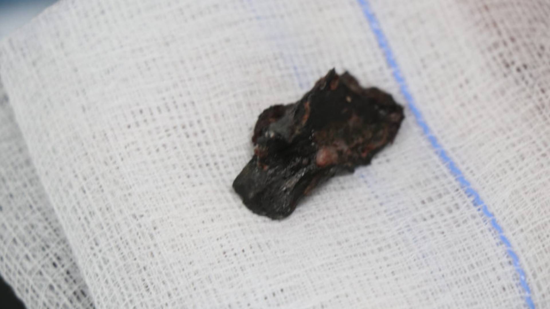 Roya News | Four-hour surgery to remove shrapnel from child’s head in ...